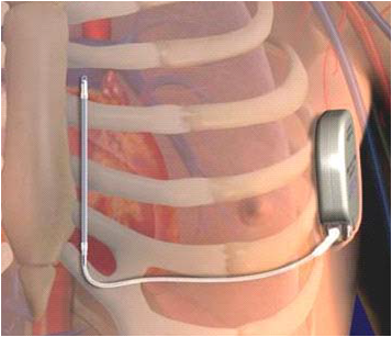 Nuevo desfibrilador funciona sin tocar el corazón | Medical Press