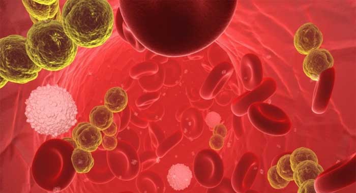 Sepsis: Causas, síntomas y tratamiento | Medical Press