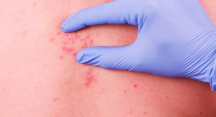Herpes Zoster: Causas y Síntomas