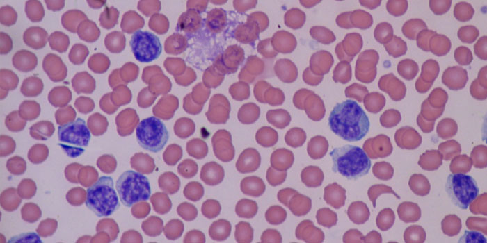 ¿Qué es la basofilia? Causas y síntomas